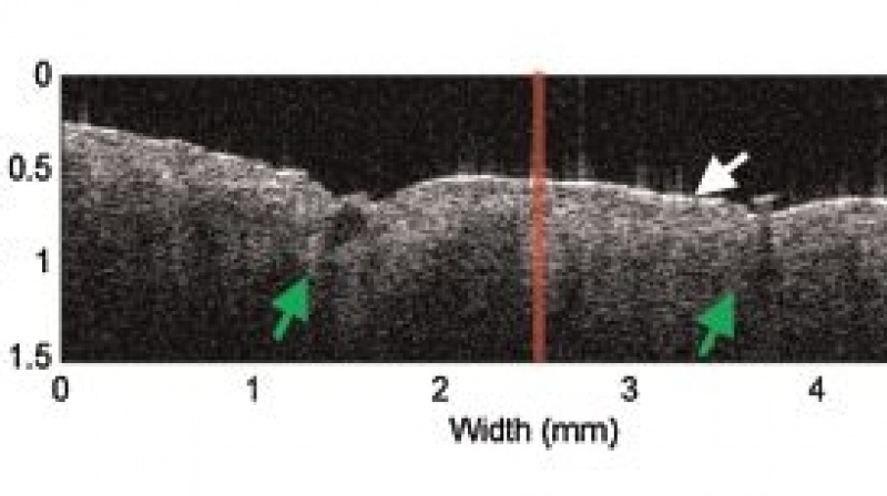 Non-Invasive Instrument for Skin Cancer Screening - Medical Design Briefs