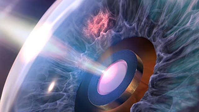 Black Silicon Prevents Eye Implant from Gumming Up - Medical Design Briefs