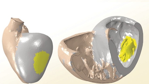 Investigating Cardiac Device Performance with Computer Modeling and ...
