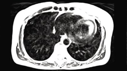 Low-Field MRI Improves Lung, Cardiac Imaging - Medical Design Briefs